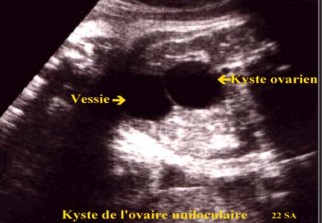 Santé : Ce qu'il faut savoir sur les kystes aux ovaires
